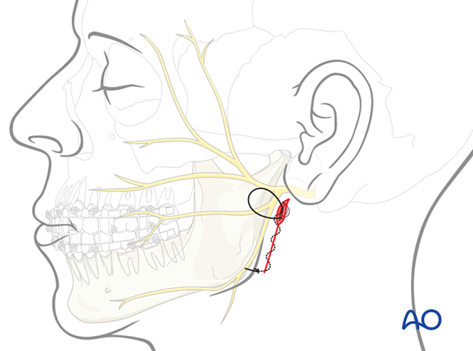 Retromandibular approaches