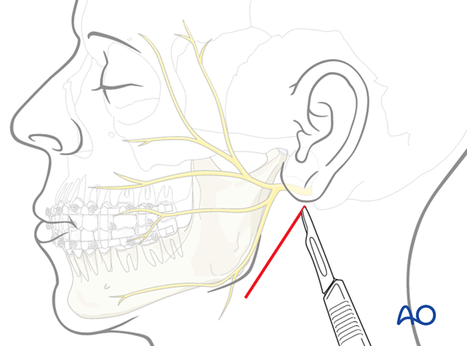 Retromandibular approaches