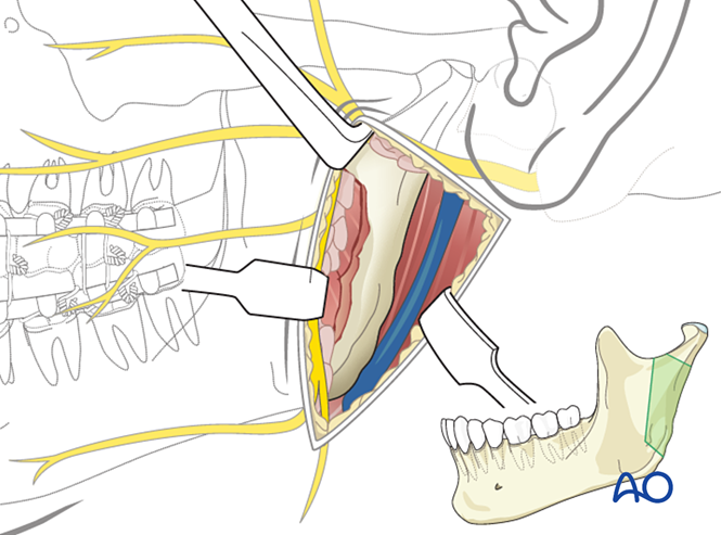 Retromandibular approaches