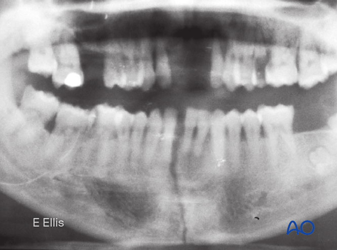 Symphysis and parasymphysis - simple