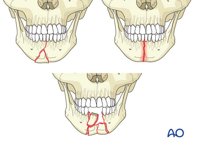 Symphysis and parasymphysis - complex