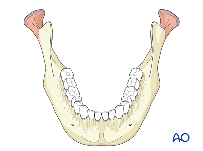 Condylar process and head - simple and complex