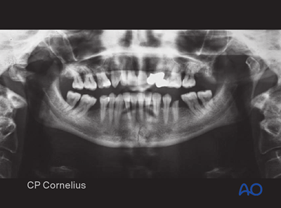 Condylar process and head - simple and complex