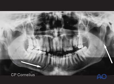 Condylar process and head - simple and complex