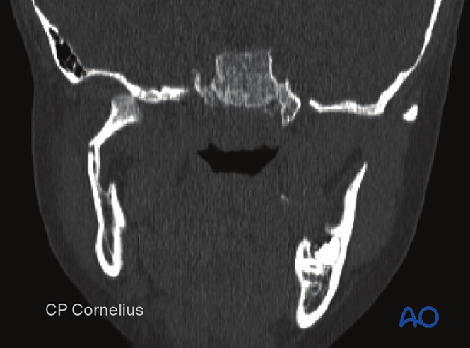 Condylar process and head - simple and complex