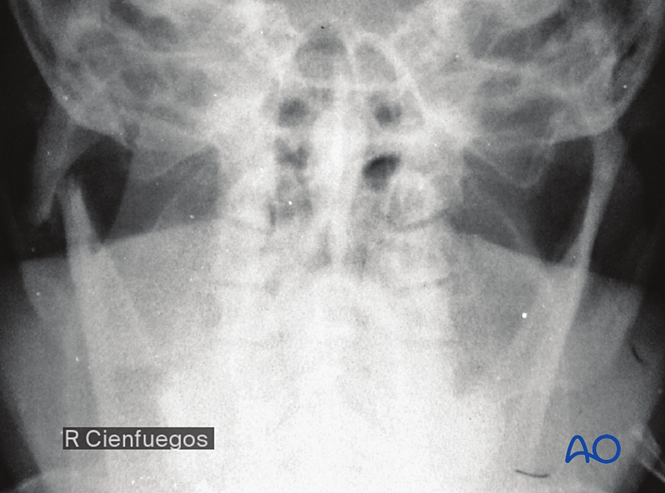 Condylar process and head - simple and complex
