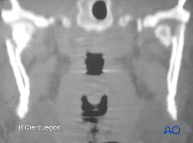 Condylar process and head - simple and complex