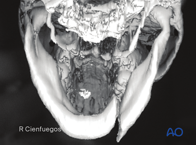 Condylar process and head - simple and complex