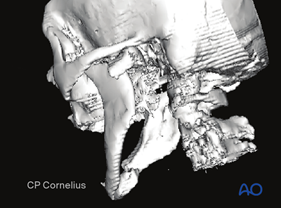 Condylar process and head - simple and complex