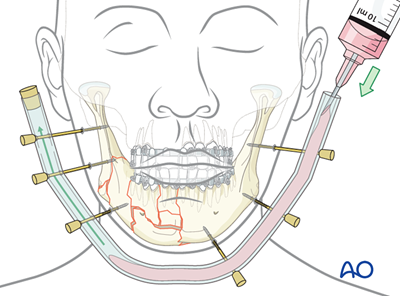 Temporary external fixator for Body - complex