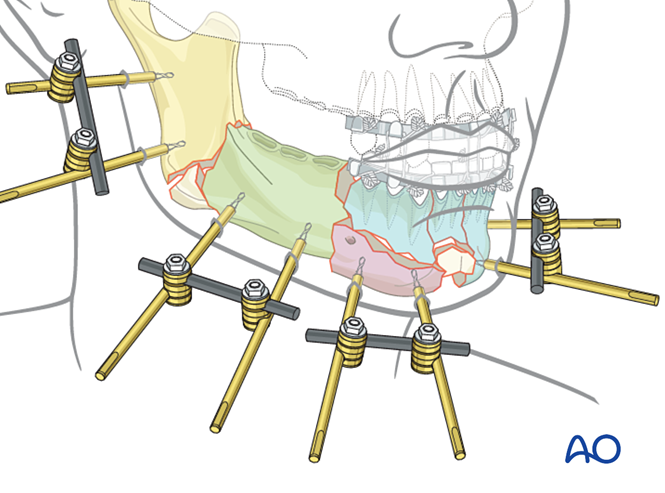 Temporary external fixator for Angle - complex