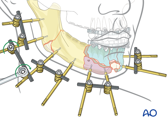 Temporary external fixator for Body - complex