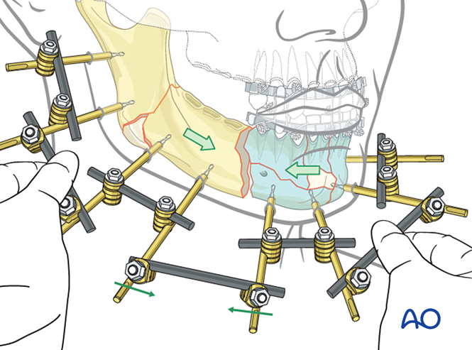 Temporary external fixator for Body - complex
