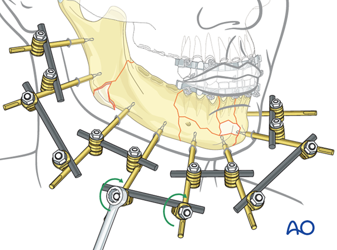 Temporary external fixator for Body - complex
