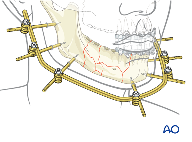 Temporary external fixator for Body - complex