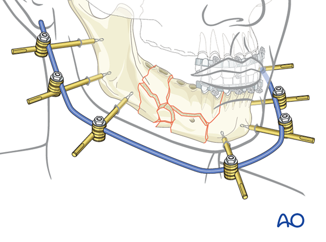 Temporary external fixator for Angle - complex