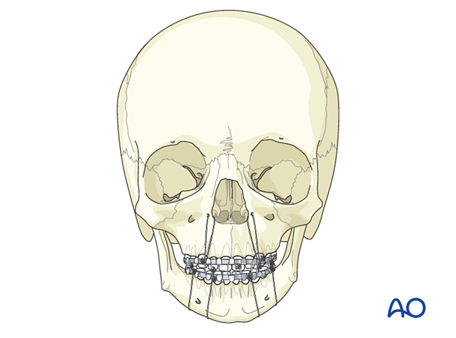 Closed treatment, MMF for Symphysis and parasymphysis - simple