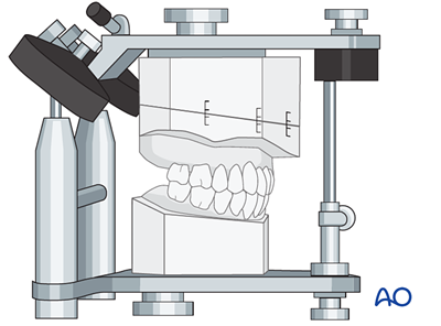 Occlusal splints for Symphysis and parasymphysis - simple