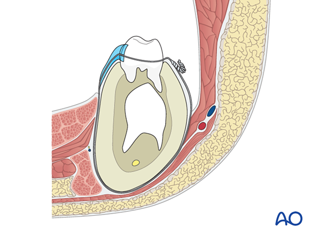 Occlusal splints for Symphysis and parasymphysis - simple