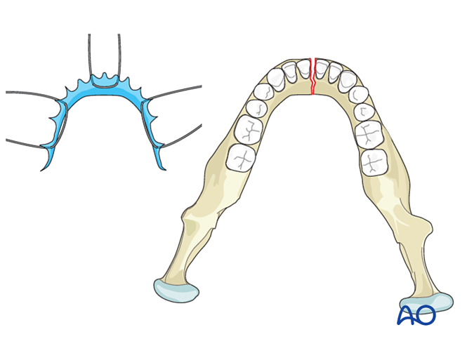 Occlusal splints for Symphysis and parasymphysis - simple