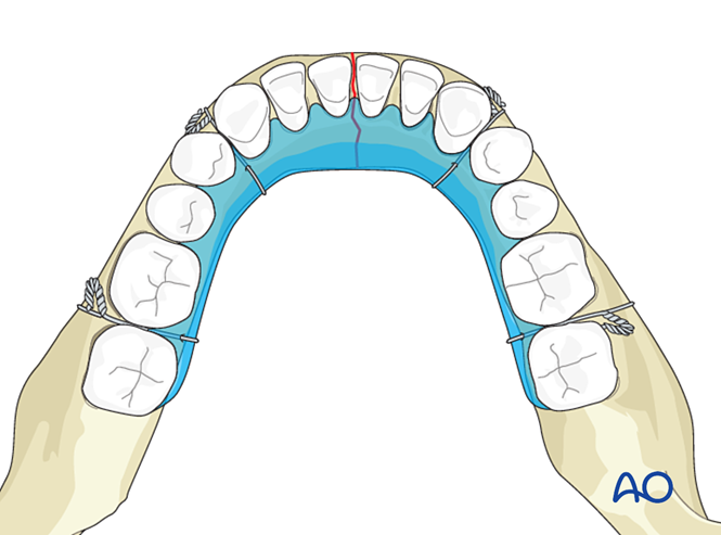 Occlusal splints for Symphysis and parasymphysis - simple
