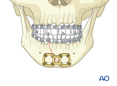 ORIF, strut plate (strut/box/ladder plate) for Symphysis and ...