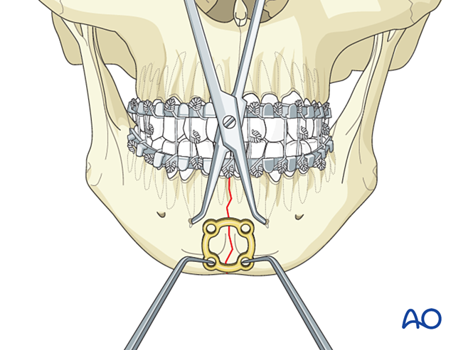 ORIF, strut plate (strut/box/ladder plate) for Symphysis and ...