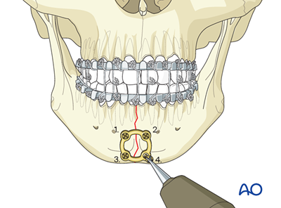 ORIF, strut plate (strut/box/ladder plate) for Symphysis and ...