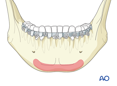 ORIF, arch bar and load-sharing plate for Symphysis and parasymphysis ...