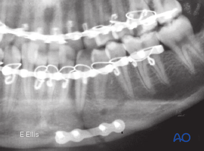 ORIF, arch bar and load-sharing plate for Symphysis and parasymphysis ...