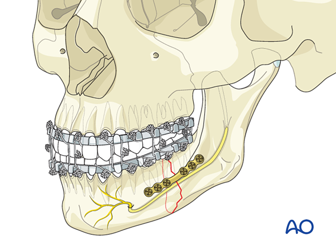 ORIF, one load sharing plate for Body - simple