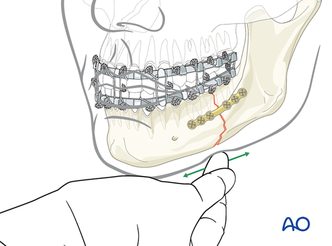 ORIF, one load sharing plate for Body - simple