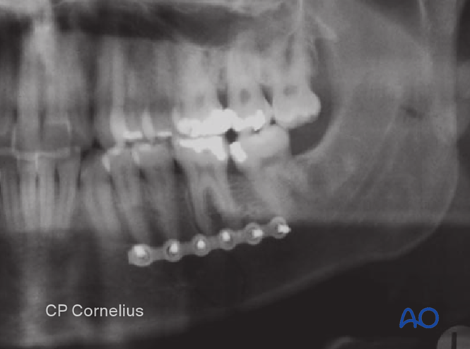 ORIF, one load sharing plate for Body - simple