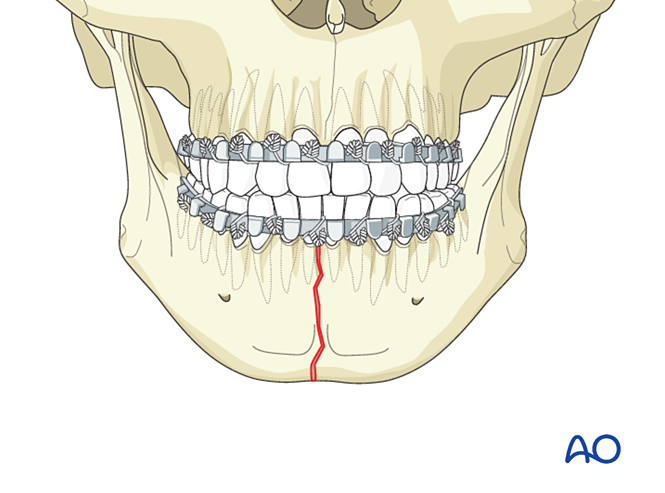 ORIF, strut plate (strut/box/ladder plate) for Symphysis and ...