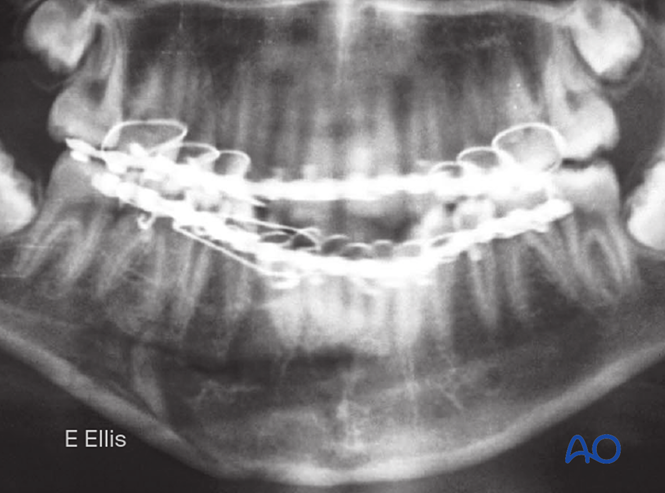 Closed treatment, MMF for Symphysis and parasymphysis - complex