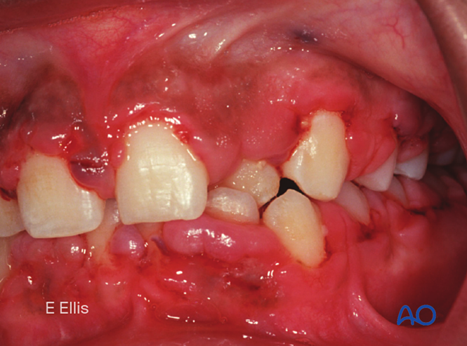 Closed treatment, MMF for Symphysis and parasymphysis - complex