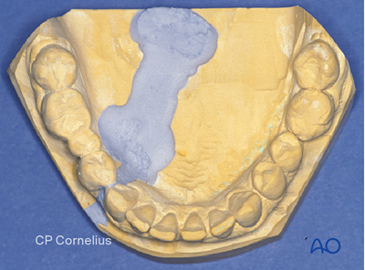 MMF for Body - complex