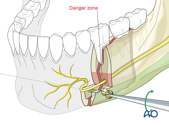 ORIF, lag screws for Body - simple
