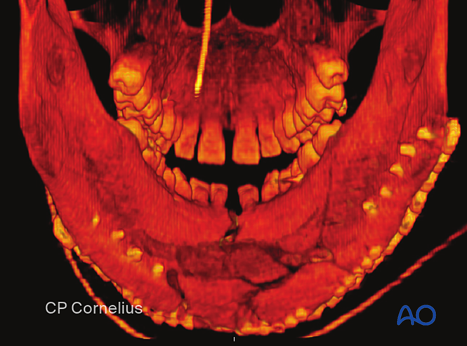 ORIF, load bearing plate with or without simplification for Body - complex