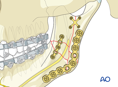 ORIF for Ramus fracture