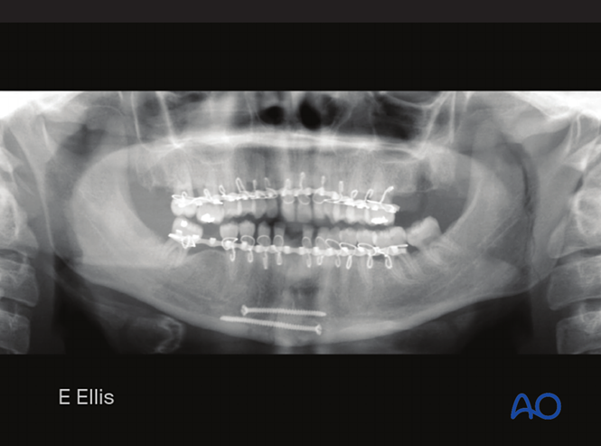 Closed treatment for Ramus fracture