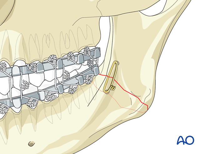 ORIF, wire for Angle - simple