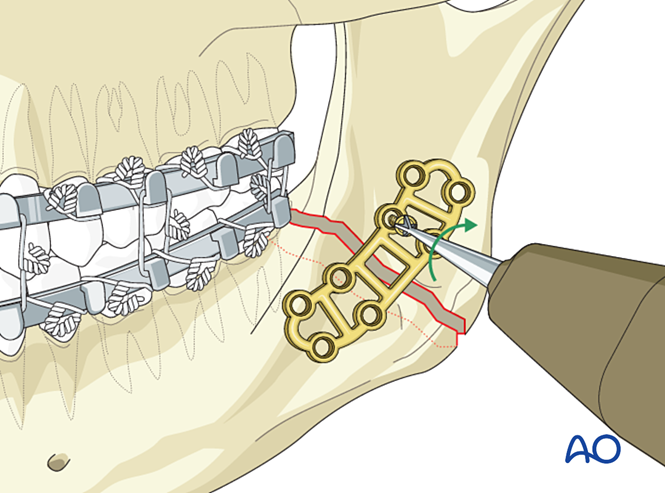 ORIF, strut plate for Angle - simple
