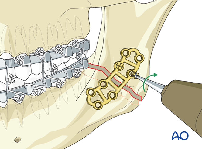 ORIF, strut plate for Angle - simple