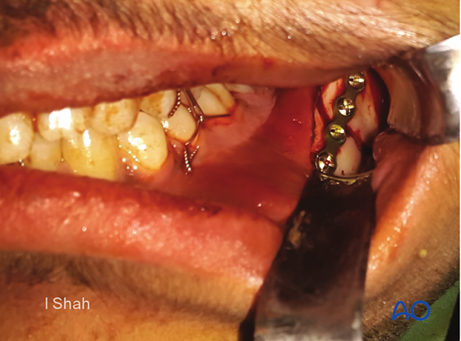 ORIF, one load sharing plate for Angle - simple