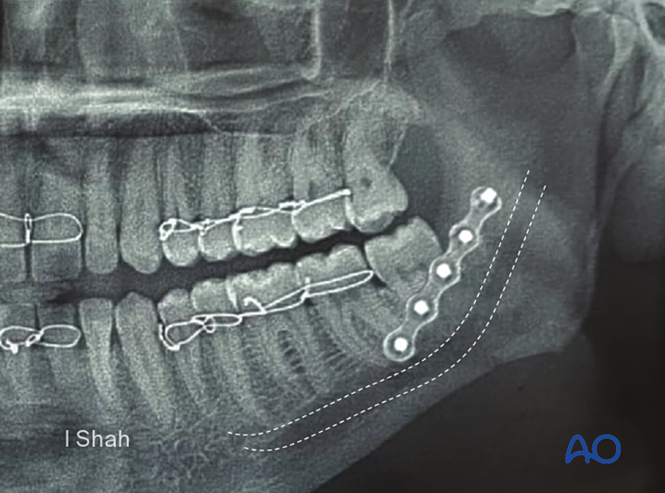 ORIF, one load sharing plate for Angle - simple