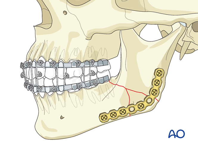 ORIF, two load sharing plates for Angle - complex