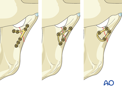ORIF, one/two plate(s) - endoscopically assisted for Condylar process ...