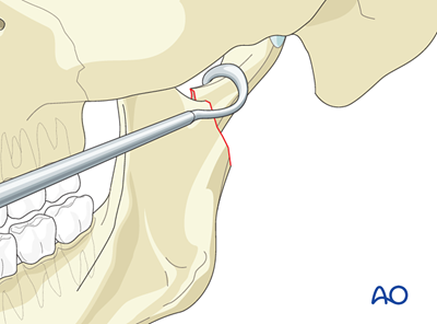 ORIF, one/two plate(s) - endoscopically assisted for Condylar process ...
