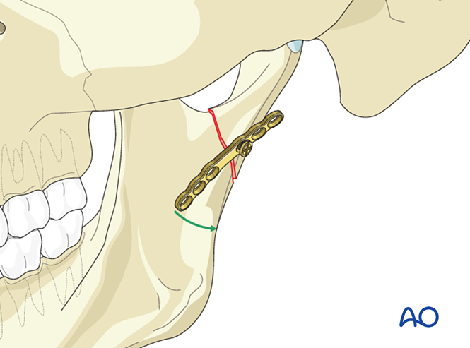 ORIF, one/two plate(s) - endoscopically assisted for Condylar process ...